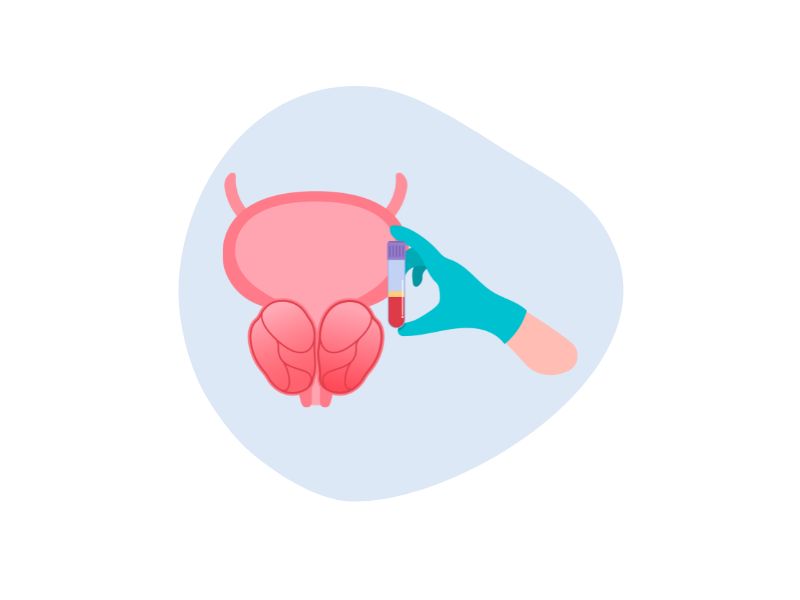 Adenom de prostata - Tratament pentru prostata marita - Synevo