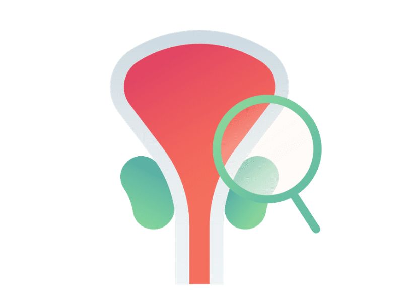 Cancer de prostata - Simptome, Tratament, Speranta de Viata | Synevo ...